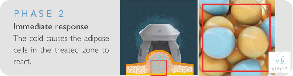 How exactly does fat-freezing technology work? - Vivify Beauty